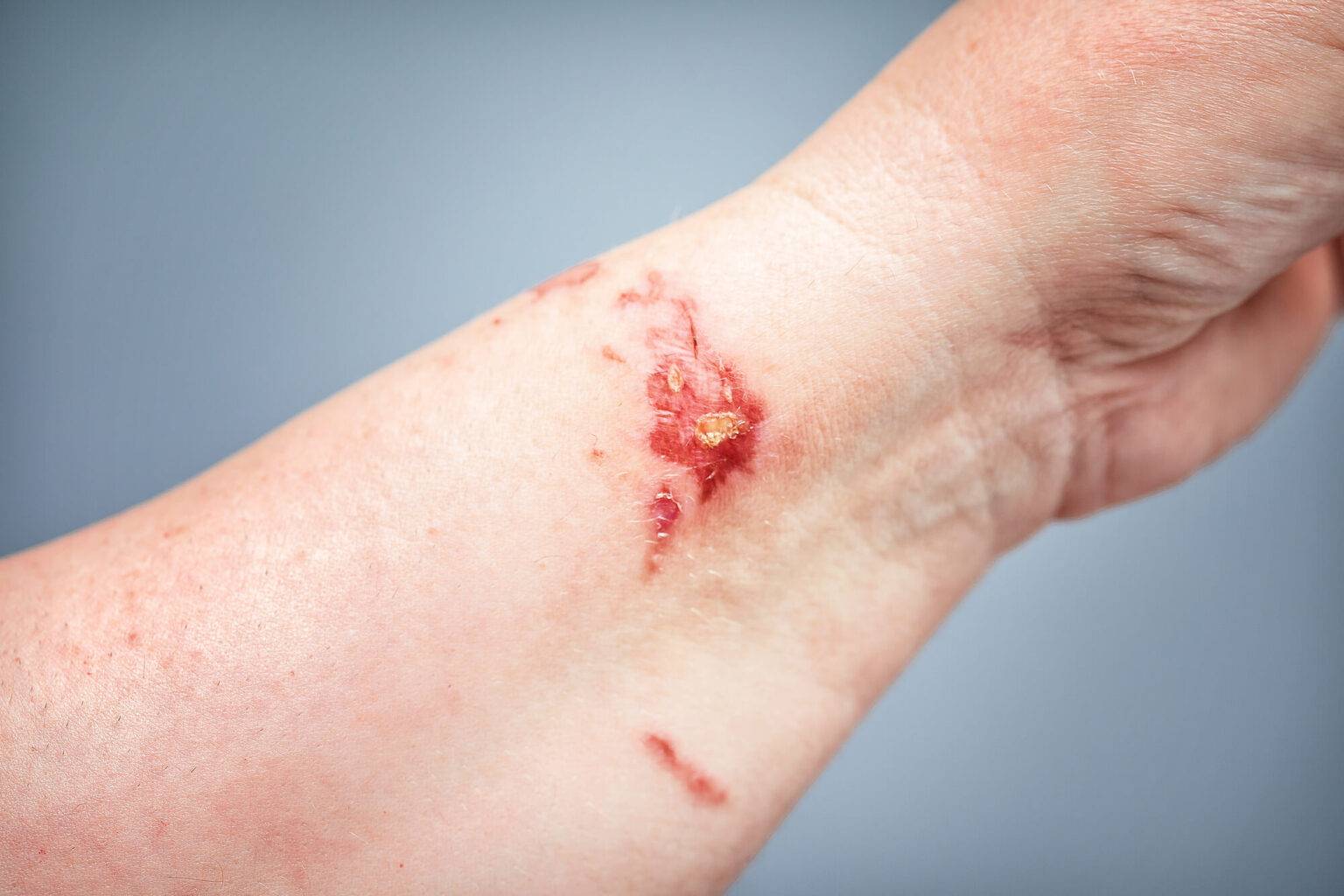 All About Burns: Chemical Burns - Family First ER - Emergency Clinic